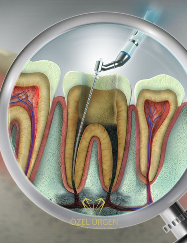 Root Canal Treatment Brooklyn - LivingArt Dentistry
